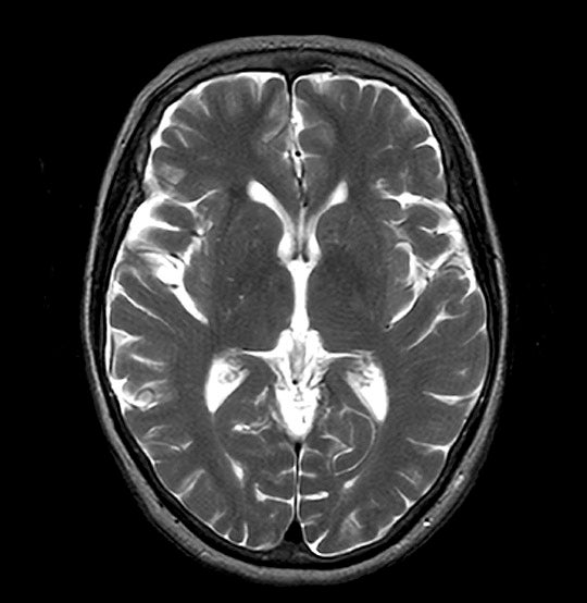 Brain MRI scan | Medserena Open MRI