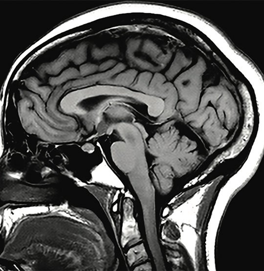 Brain, CCJ and Cervical Spine MRI scan | Medserena Open MRI