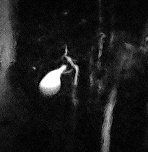 Gall Bladder MRCP MRI scan | Medserena Open MRI