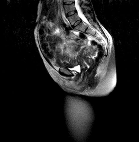 Pelvic Floor MRI scan | Medserena Open MRI